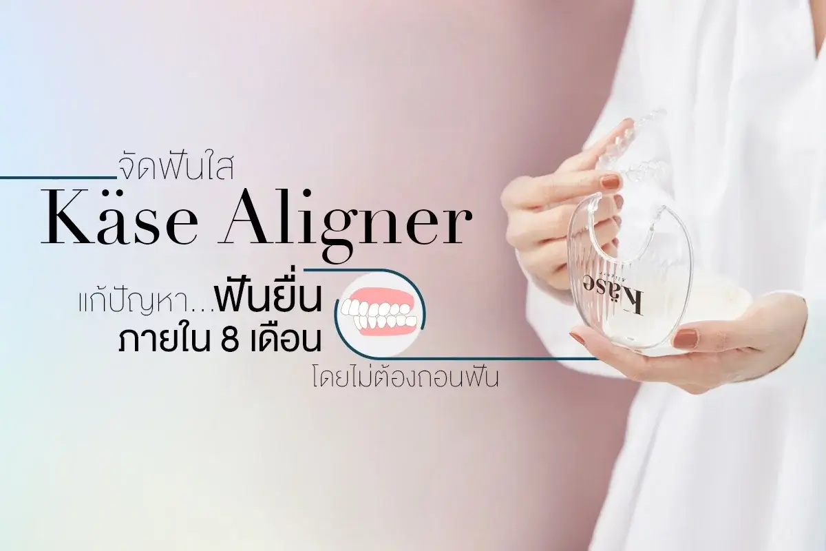 จัดฟันใส Käse Aligner แก้ปัญหาฟันยื่น ภายใน 8 เดือน โดยไม่ต้องถอนฟัน