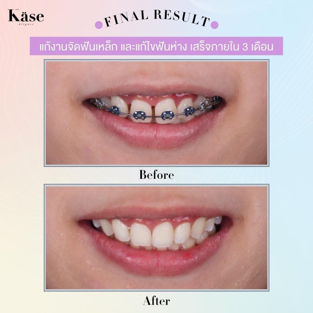 จัดฟันใส Käse Aligner - kasealigner