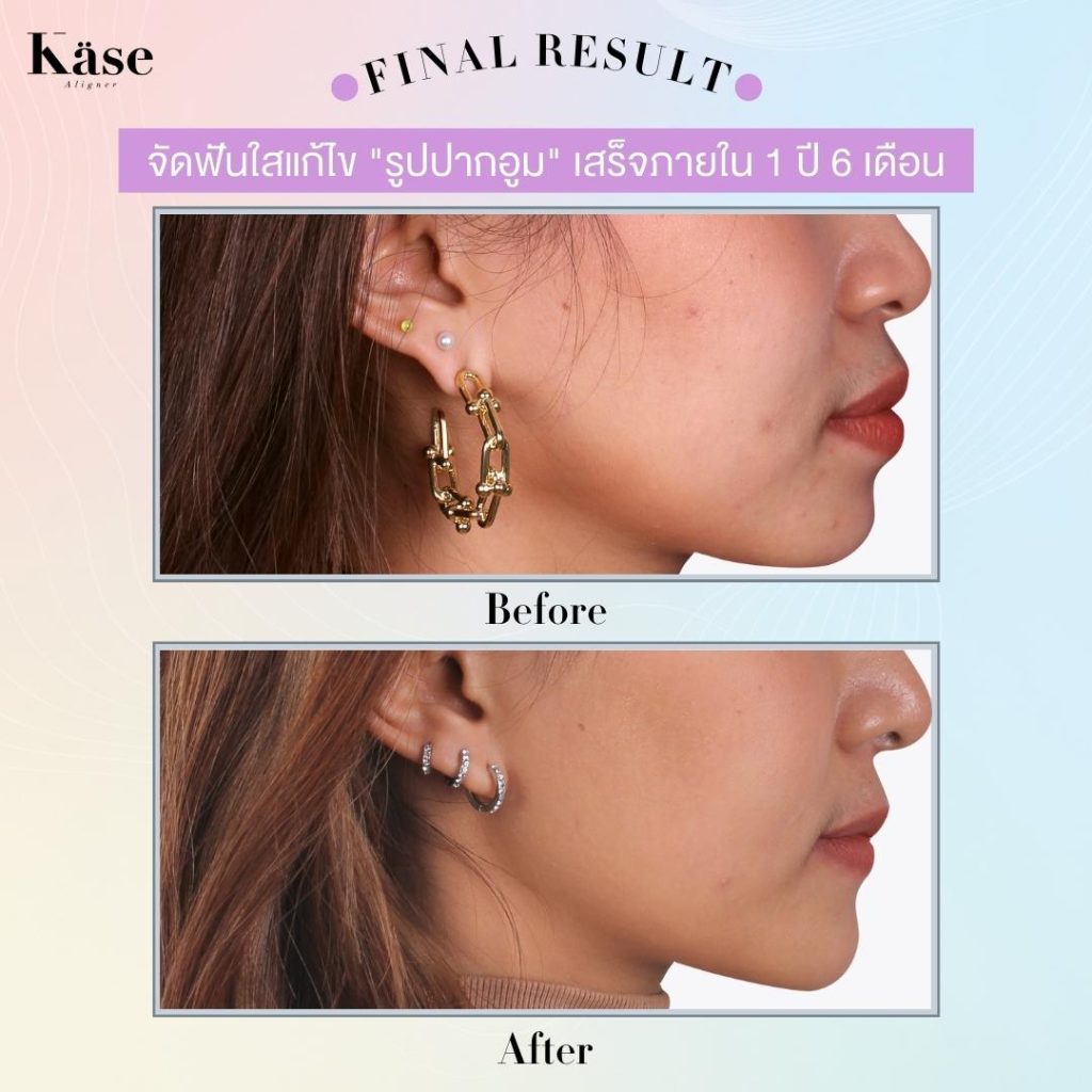 จัดฟันใส Käse Aligner - kasealigner