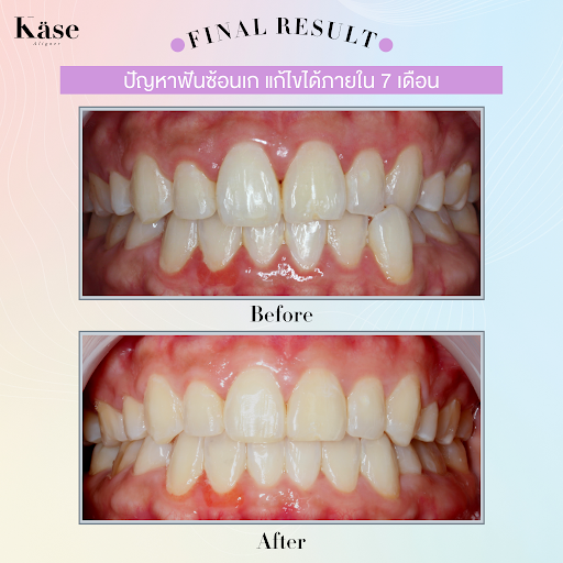 จัดฟันใส Käse Aligner Archives - kasealigner