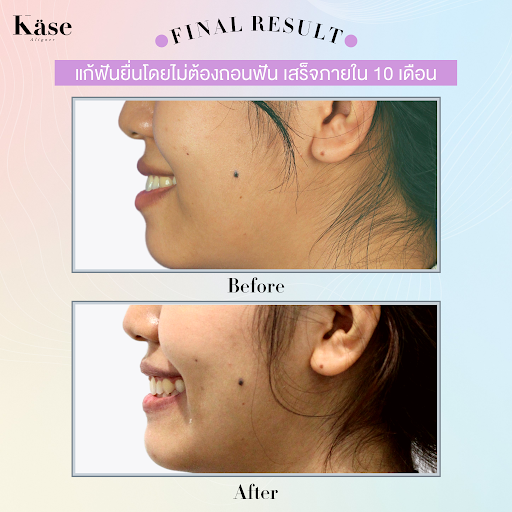 จัดฟันใส Käse Aligner Archives - kasealigner