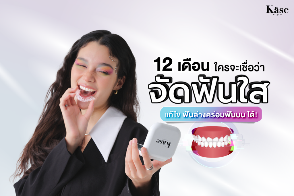 หมดปัญหา ยิ้มไม่สวย เส้นกึ่งกลางฟัน ไม่ตรงกัน ด้วยจัดฟันใสเพียง 4 เดือนครึ่งเท่านั้น - kasealigner